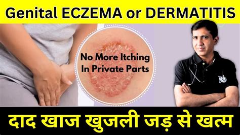 Genital Eczema Or Genital Dermatitis Causes Symptoms And Treatment By Dr Ramdeo Lamoria