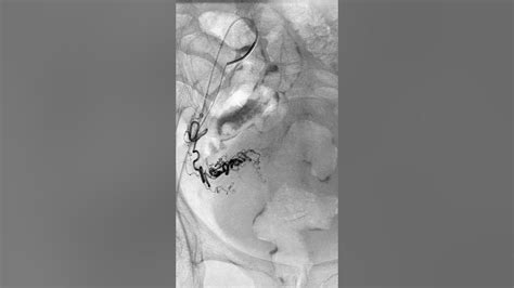 How Ir Helpsgynecologists Pelvic Bleed Controlled With Embolization