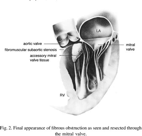 Figure 2 From Congenital Subaortic Stenosis By Accessory Mitral Valve