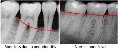 Negative Effects Of Periodontal Disease Nha Khoa No1