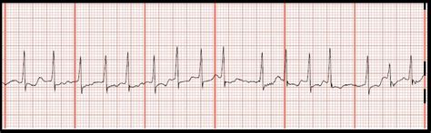 Practice Ekg Rhythm Strips 120