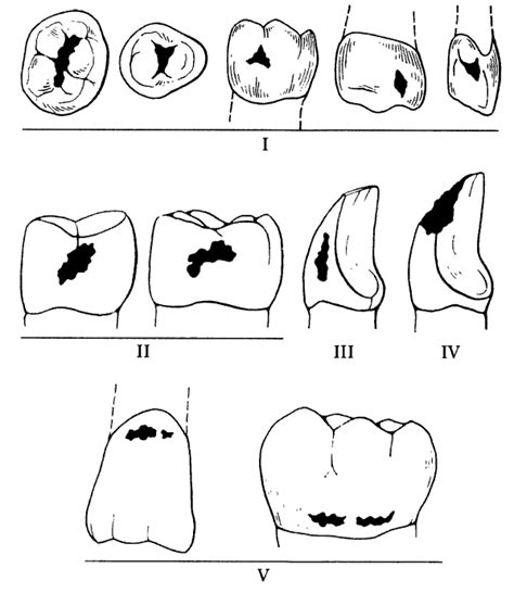 Classification Des Caries Dentaires En Dentisterie En Images En Noir