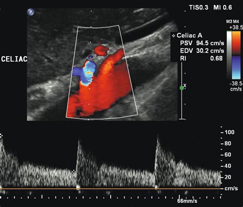 Mesenteric Arteries Thoracic Key