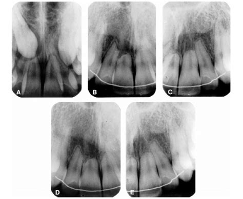 Radiographs Of A Patient Aged 21 Years With Severe Apical Root Download Scientific Diagram