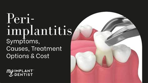 Peri Implantitis Symptoms Causes Treatment Options And Cost