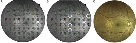 Measurement Of Retinal Sensitivity Using Microperimetry Retinal