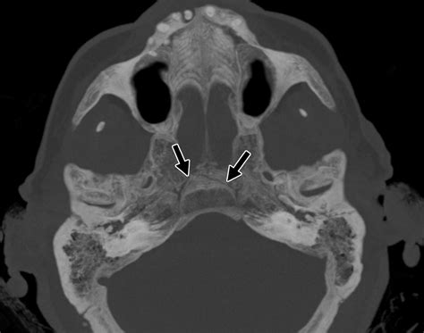 Ct Of Skull Base Fractures Classification Systems Complications And