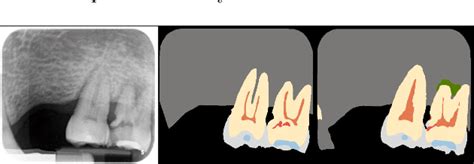 Figure 1 From Multi Class Semantic Segmentation Of Tooth Pathologies And Anatomical Structures