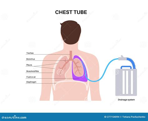 Chest Tube Catheter Vector Illustration 277154094