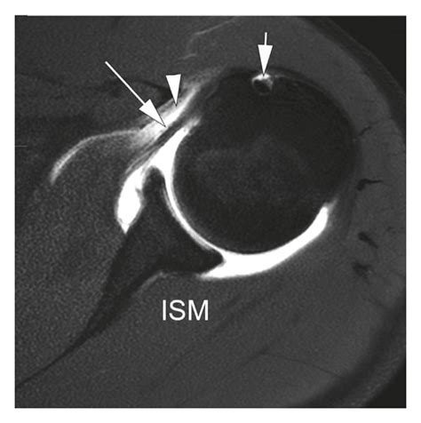 Normal Mr Arthrogram Axial T1 Weighed Fs A And Sagittal T1 Weighted