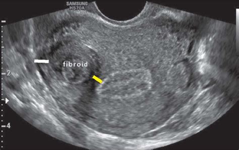 Brazil Reporting Of Uterine Fibroids On Ultrasound Examinations An