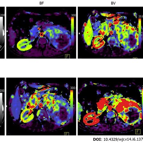 Pre Treatment A And Post Treatment B Computed Tomography Perfusion