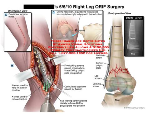 Amicus Illustration Of Amicussurgerylegorifincisioncurvilineark