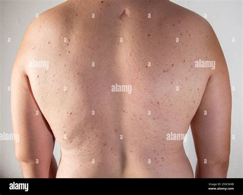 Red Pimples On A Mans Back Hormonal Imbalance And Increased