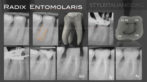 Radix Entomolaris Case Series And Clinical Considerations Style Italiano Endodontics