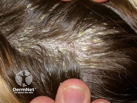 Plaque Psoriasis On Scalp