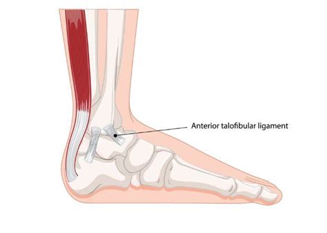 Acute And Chronic Atfl Tears Dr Karnav Panchal
