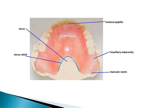 Maxillary Denture Landmarks Pptx