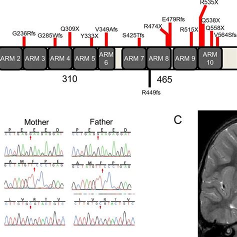 De Novo Mutation In Tuba1a Encoding α Tubulin A Tuba1a Functional