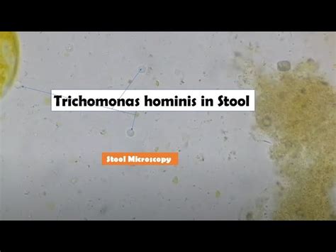 Trichomonas Hominis In Stool Treatment