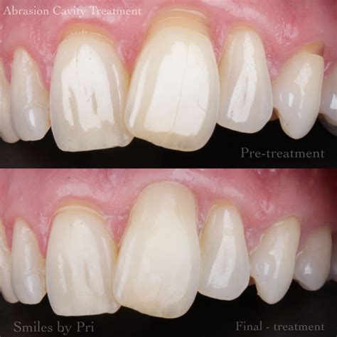 Abrasion Wear Dr Pri