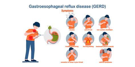 Gastroesophageal Reflux Disease Initial Assessment Mims Philippines