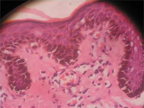 Plasma Cell Our Dermatology Online