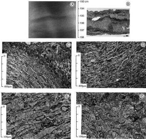 A X Radiograph Showing Light Toned Current Lain Sediment With Wavy