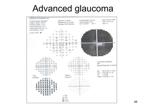 Primary Open Angle Glaucoma Presentation Ppt