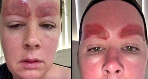 Moms Eyebrow Skin Peels Off After Microblading Procedure Goes Terribly Wrong