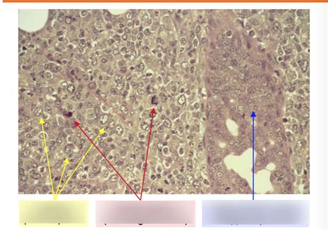 Diagram Of Cancer Lct 1 Quizlet