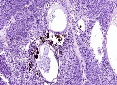 Pigmented Basal Cell Carcinoma