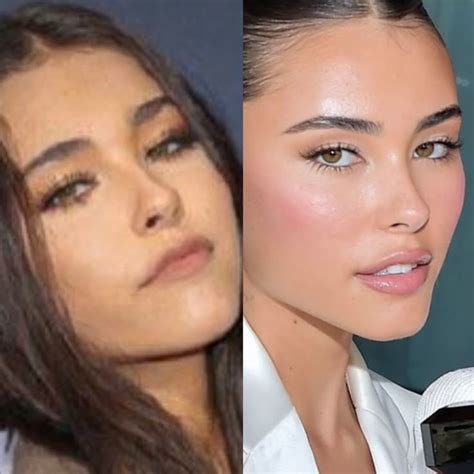 Madison Beer Plastic Surgery Facial Aesthetics Plastic Surgery Chin