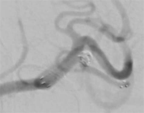 Treatment Of Left Mca Aneurysm