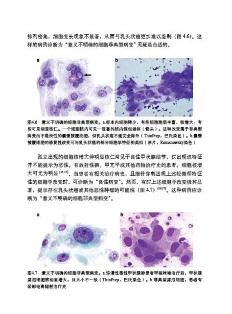 非典型腺细胞液基细胞学正常图颈管细胞大山谷图库