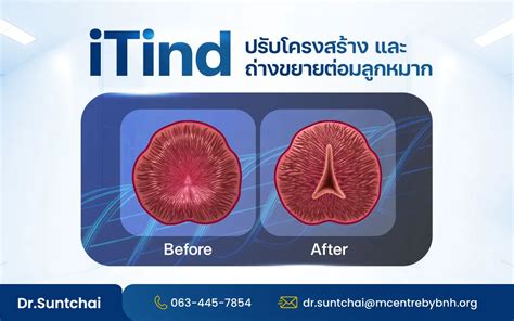 Itind เทคโนโลยีในการรักษาโรคต่อมลูกหมากโต Drsuntchai