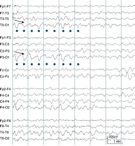 The Abnormal Eeg Neupsy Key