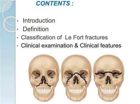 Le Fort Fracture عيون لطب الاسنان دكتور احمد اسامة هاشم Ppt