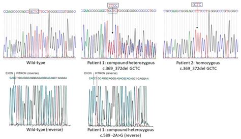 Leu124serfs26 A Novel Agpat2 Mutation In Congenital Generalized