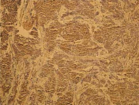 immunohistochemical expression of neuron specific enolase nse in