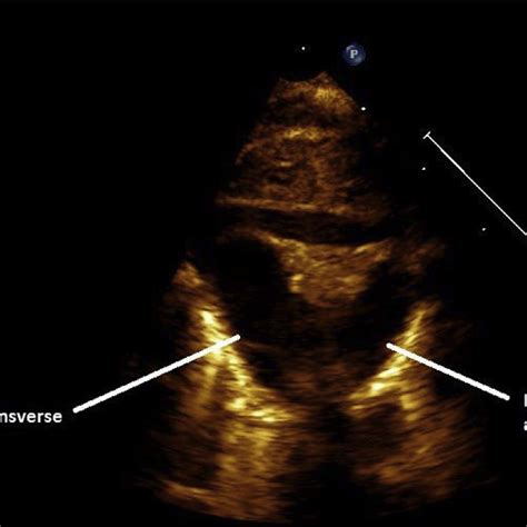 Suprasternal Frontal View Demonstrates A Left Transverse And Right