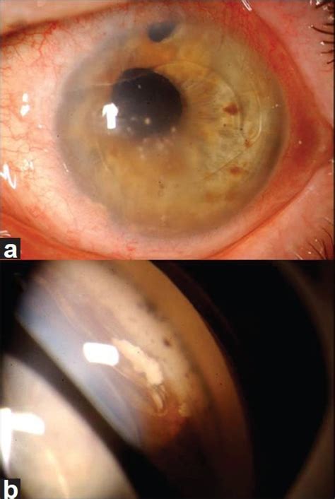 Asteroid Hyalosis Ah Eyewiki