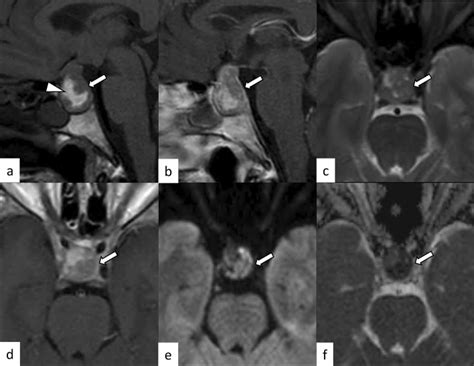 Neuroimaging Of Hypophysitis Etiologies And Imaging Mimics Pmc