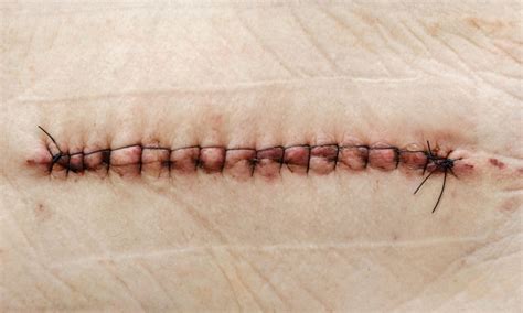 Explore Various Types Of Suture Patterns For Surgery
