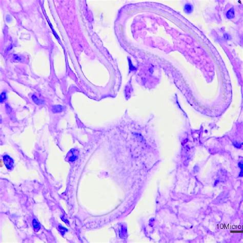 Longitudinal Section Of A Nematode Was Found With Infiltrations Of Download Scientific Diagram
