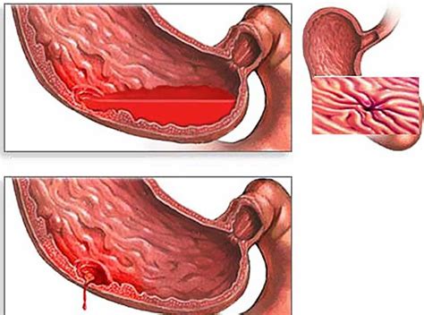 Melena Y Hemorragia Digestiva Como Se Dice Heces Con Sangre En