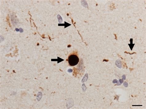 Cortical Lewy Body And Lewy Neurites Visualization Of Cortical Lewy