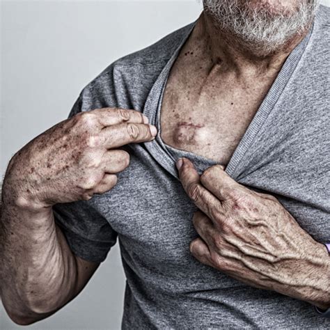 Dr Katib Condition Portacath And Vascular Access Dr Nedal Katib