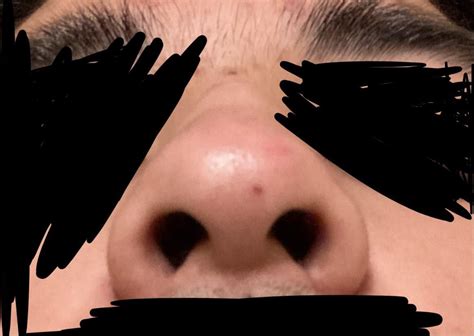 Flat Mole Removal Rplasticsurgery