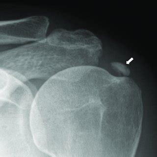 Shoulder Calcification